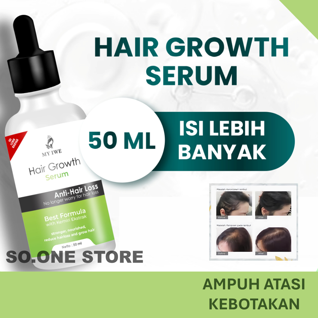 Jual Myiwe Hair Growth Serum Penumbuh Rambut Botak dan Cegah Rontok ...