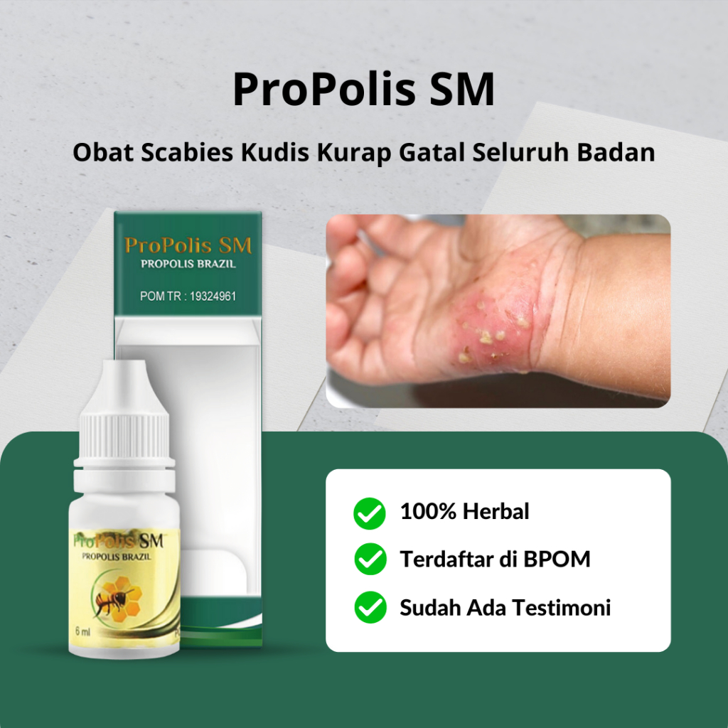 Jual Propolis SM - Obat Scabies Kudis Kurap Ruam Kulit Gatal Seluruh ...