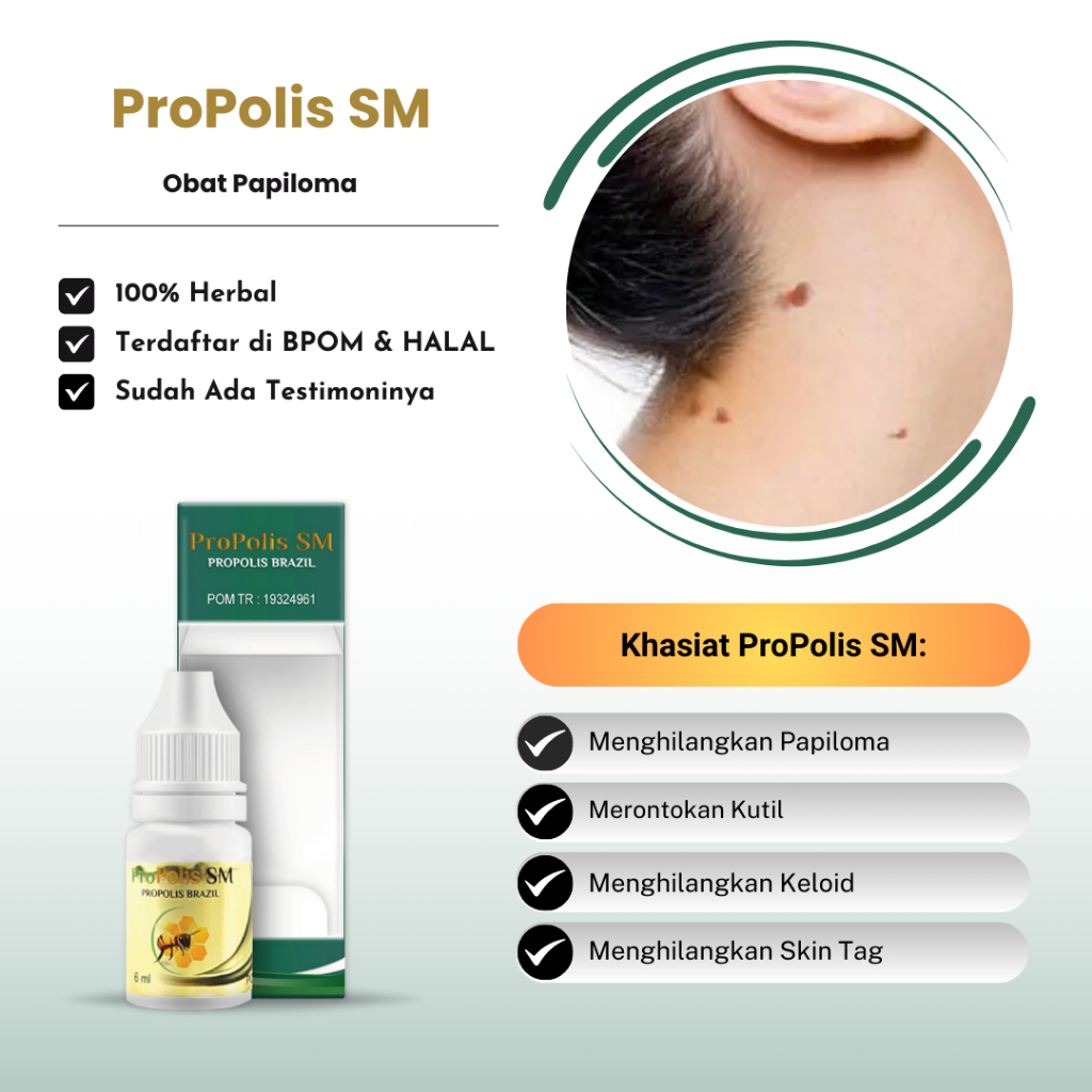 Jual Propolis SM - Obat Papiloma Kutil di Leher Skin Tag Keloid Daging ...
