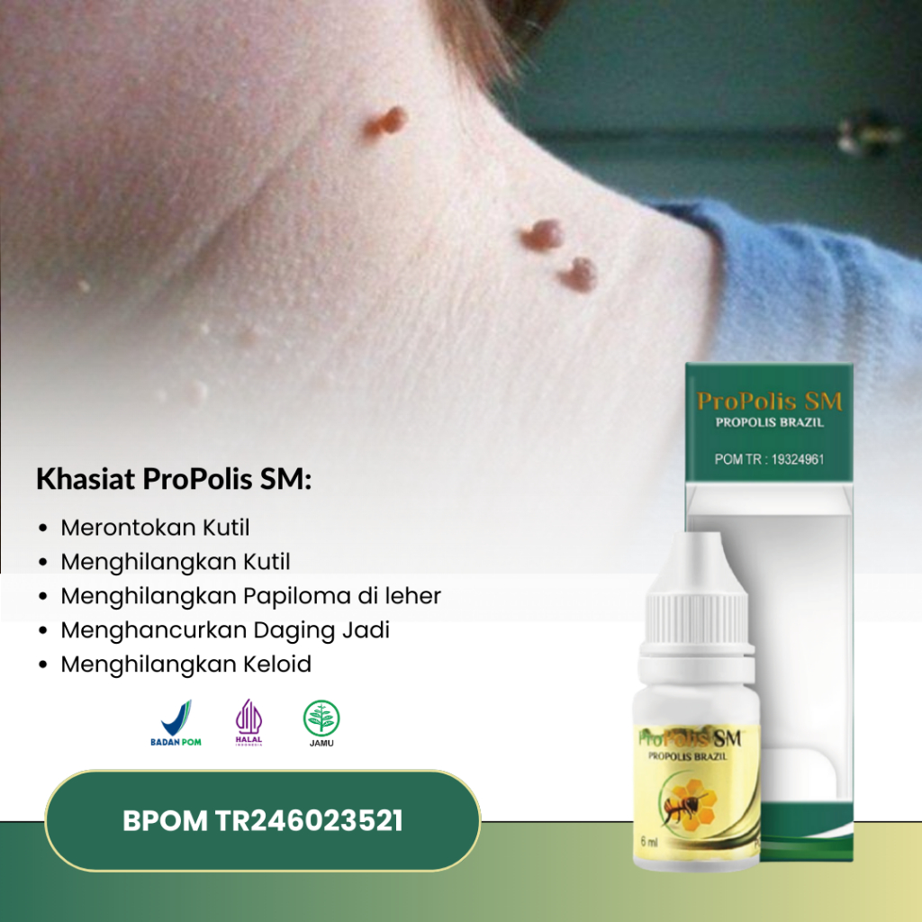Jual Obat Perontok Kutil, Obat Penghilang Papiloma di Leher dan Wajah ...