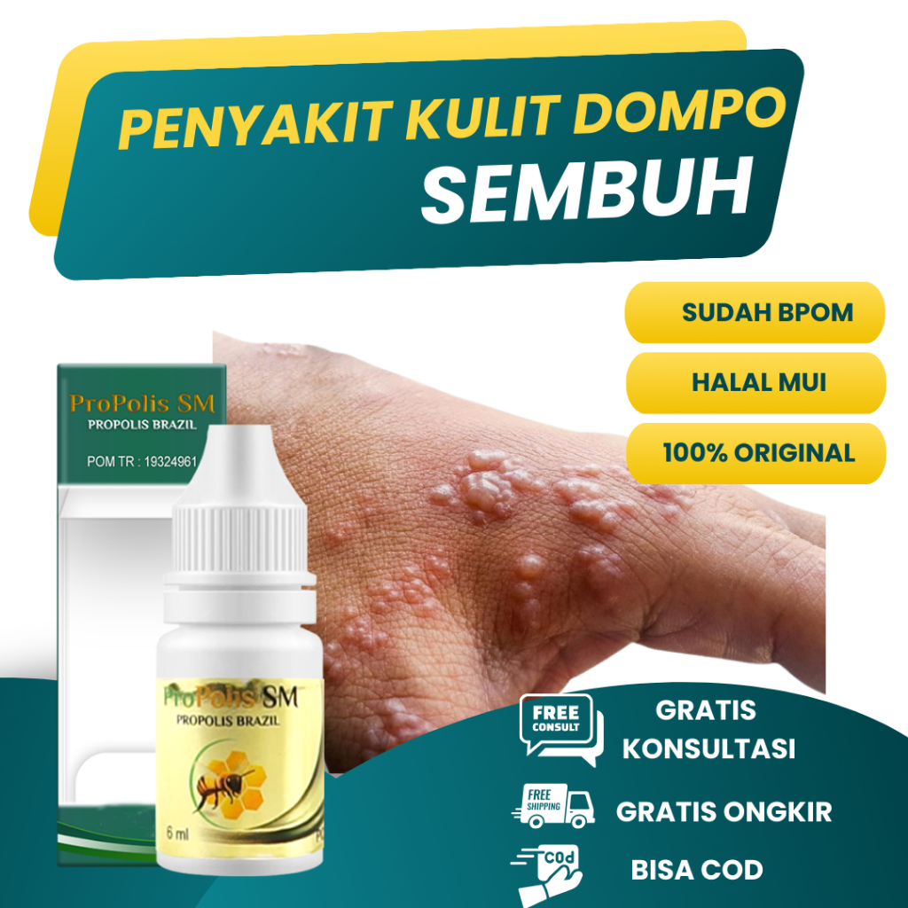Jual Obat Dompo Penyakit Kulit Herpes Zoster Propolis Sm Brazilian 100% ...
