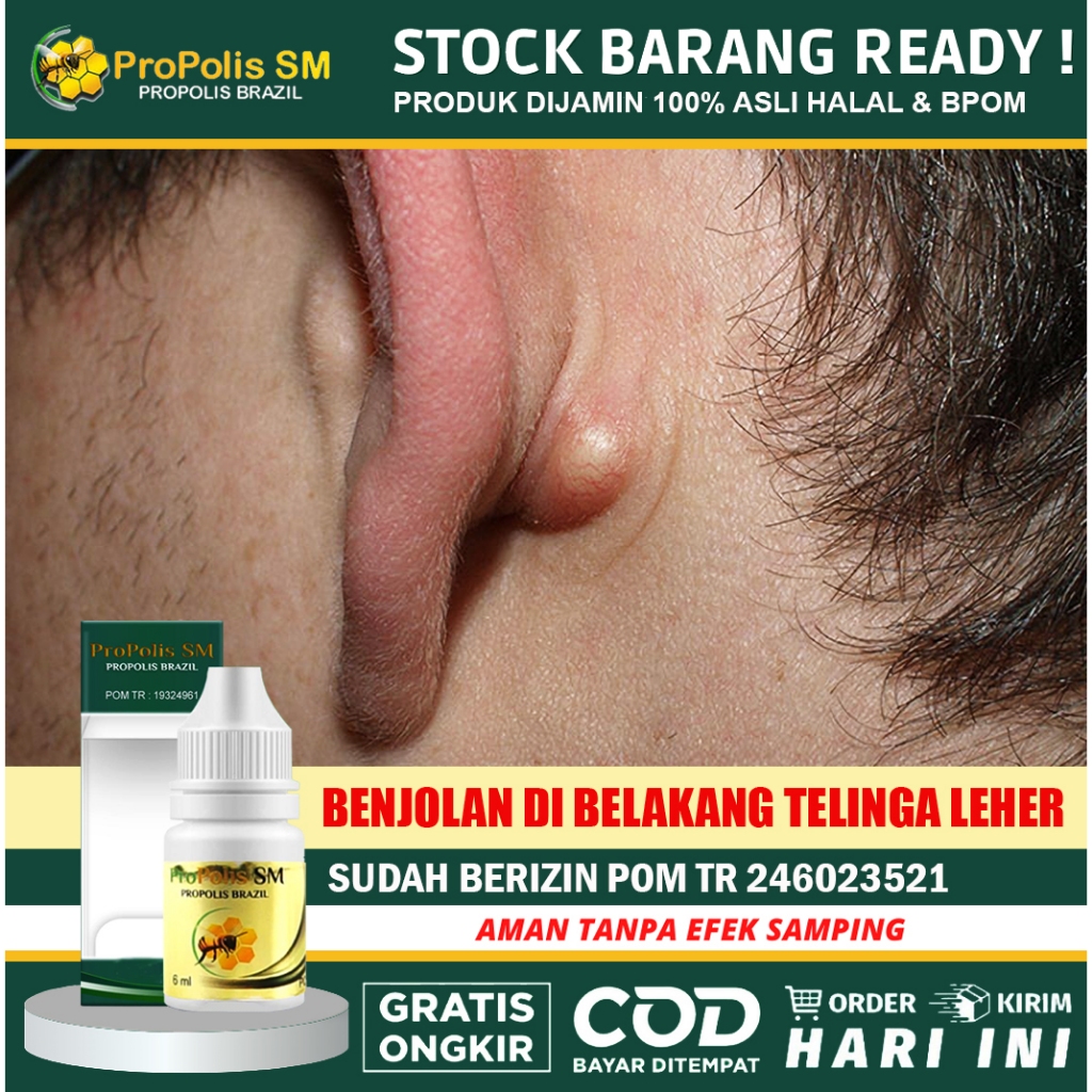 Jual Obat Penghilang Benjolan, Benjolan Di Belakang telinga, Benjolan ...