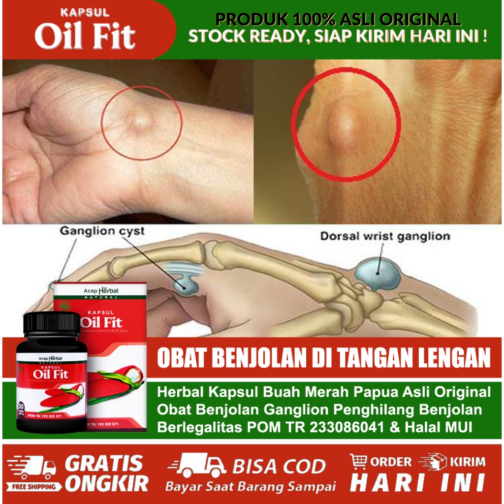 Jual Obat Benjolan Ganglion Obat Benjolan di Tangan Benjolan di Lengan ...