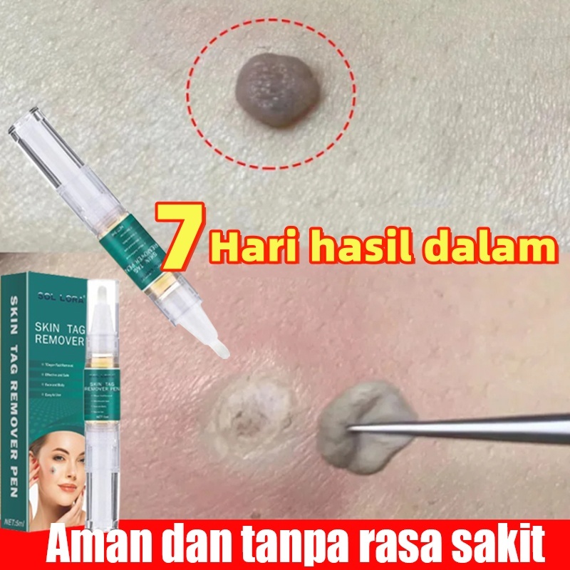 Jual Penghilang tahi lalat di wajah Penghilang Kutil Dan Tahi Lalat ...