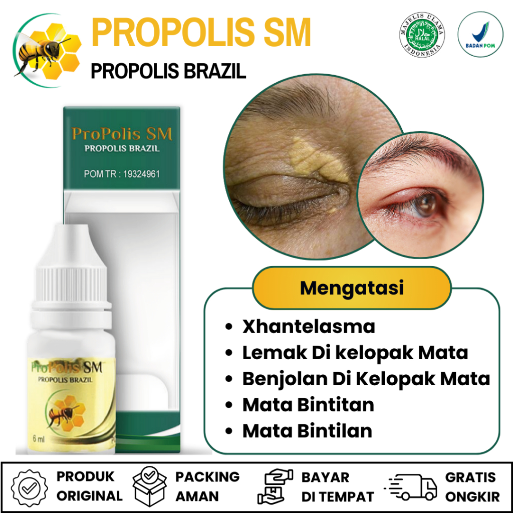 Jual Obat Xhantelasma Lemak Di Kelopak Mata Milia Mata Bintitan ...