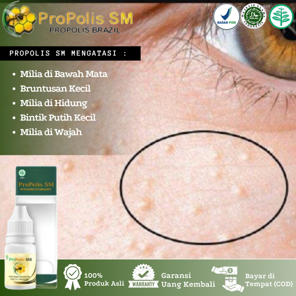 Jual Propolis SM - Obat Penghilang Milia, Milia Di Bawah Mata, Milia Di ...