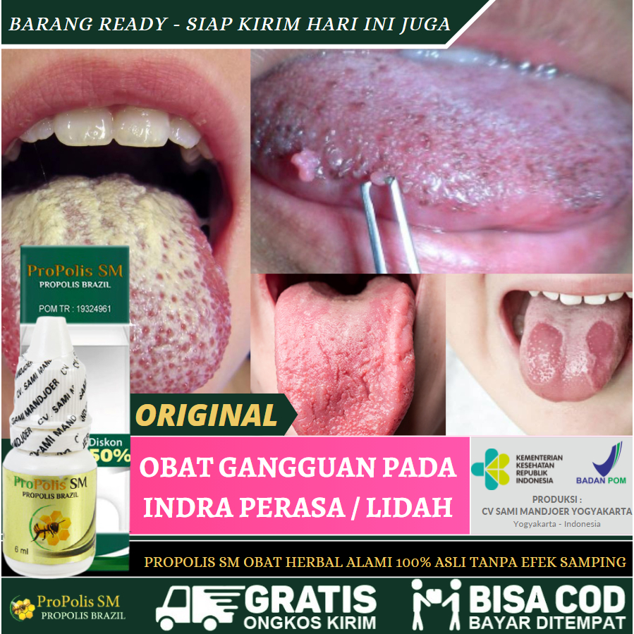 Jual Obat Penghilang Jamur Putih di Lidah, Obat Lidah Pecah - Pecah ...
