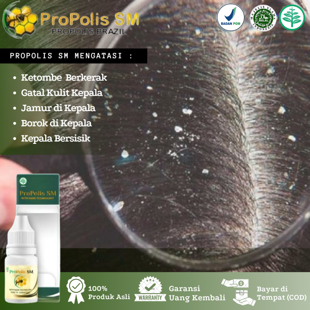 Jual Obat Ketombe Berkerak, Jamur Kulit Kepala, Psoriasis, Dermatitis di Kepala, Kepala Kering ...