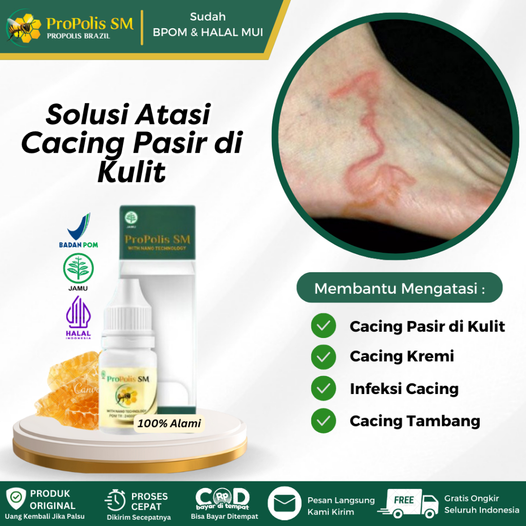 Jual Obat Cacing Pasir di Kulit, Cacing Kremi Anak, Infeksi Cacing ...
