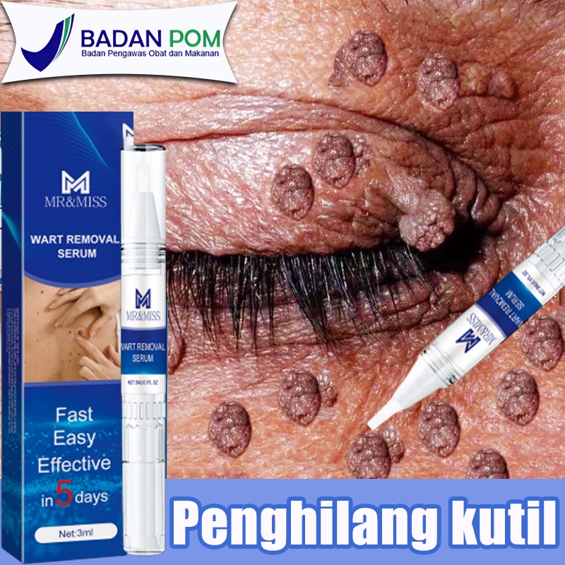 Jual Penghilang kutil Penghilang tahi lalat di wajah Penghilang kutil ...