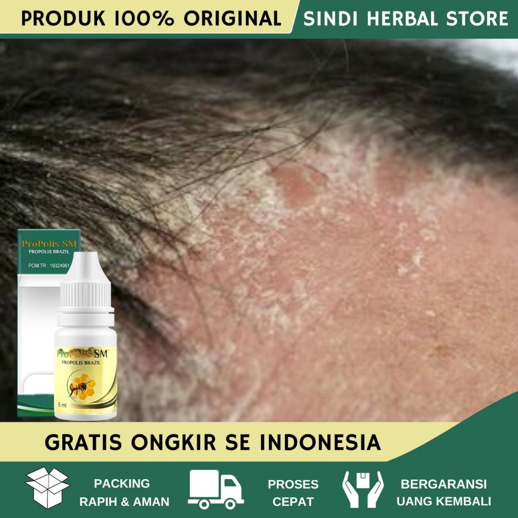 Jual Obat Ketombe Parah, Obat Ketombe Berkerak di Kepala, Obat Ketombe Parah Menahun, Obat Borok ...