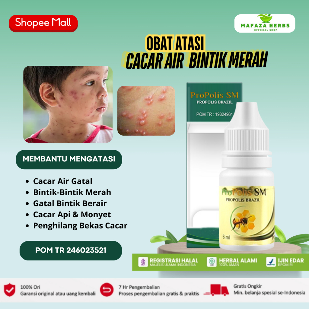 Jual Obat Cacar Air Bintik Bintik Merah Berair Cacar Api Cacar Monyet ...