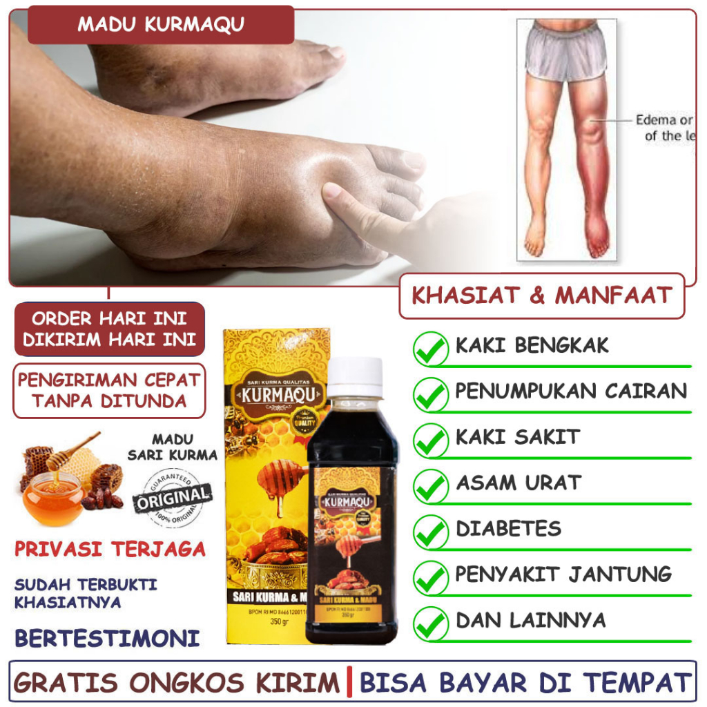 Jual Obat Kaki Bengkak Penumpukan Cairan Edema Sakit Kaki Nyeri Dan ...