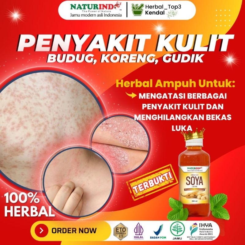 Jual 𝗢𝗕𝗔𝗧 𝗕𝗨𝗗𝗨𝗚 𝗞𝗢𝗥𝗘𝗡𝗚 𝗚𝗨𝗗𝗜𝗞 Obat Budug Di Kaki, Obat Budug Santri ...