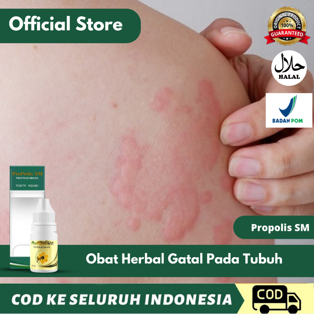 Jual Obat Gatal Pada Tubuh, Panu, Kudis, Biduran, Prurigo, Jamur, Basah ...