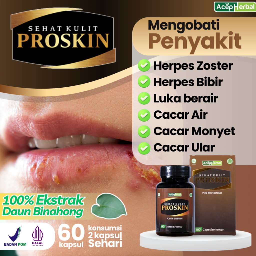 Jual Obat Herpes Zoster, Obat Herpes Bibir, Obat Luka Berair, Obat ...