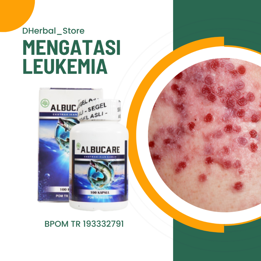 Jual Albucare, Obat Kelebihan Darah Putih Leukosit Tinggi Leukimia ...