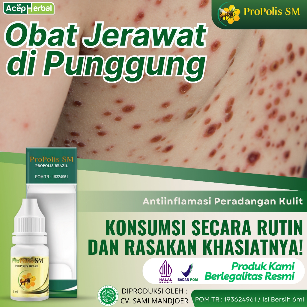 Jual Obat Jerawat Punggung, Obat Scabies Bernanah, Obat Gigi Berlubang ...
