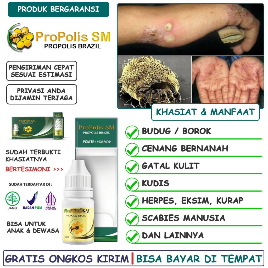 Jual Obat Budug Kulit Gatal Kudis Scabies Manusia Cenang Bernanah Borok ...