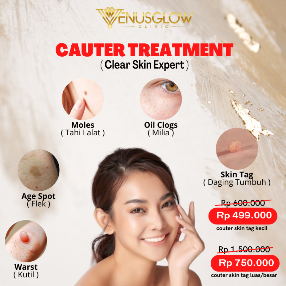 Jual Cauter Treatment | Shopee Indonesia