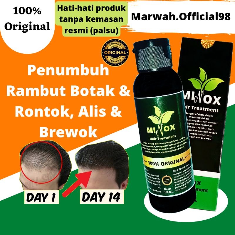 Jual [MINOX] Obat Penumbuh Rambut Botak, Tipis dan Rontok Super Cepat ...