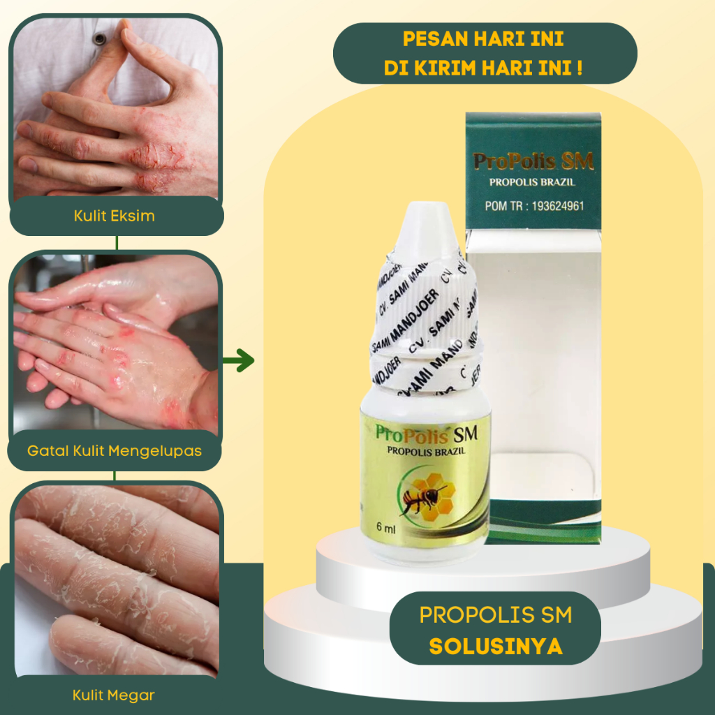 Jual Obat Jari Tangan Kering - Obat Gatal Telapak Tangan Kasar Kulit ...