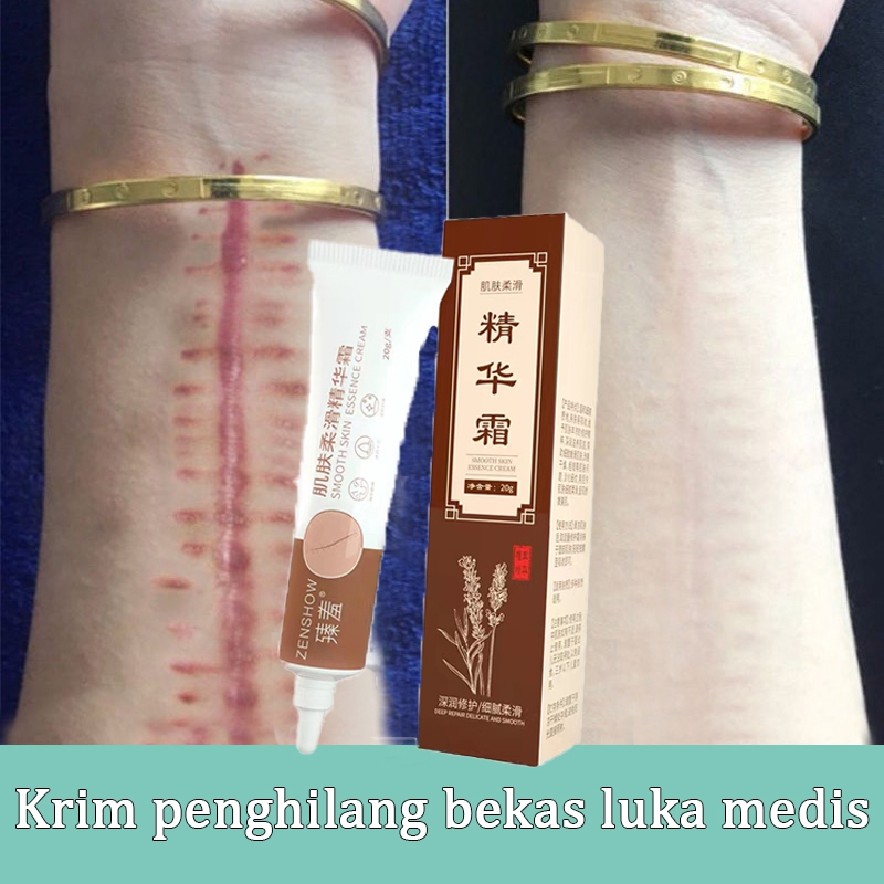 Jual Krim Cream Salep penghilang luka bekas Menghilangkan stretch mark ...