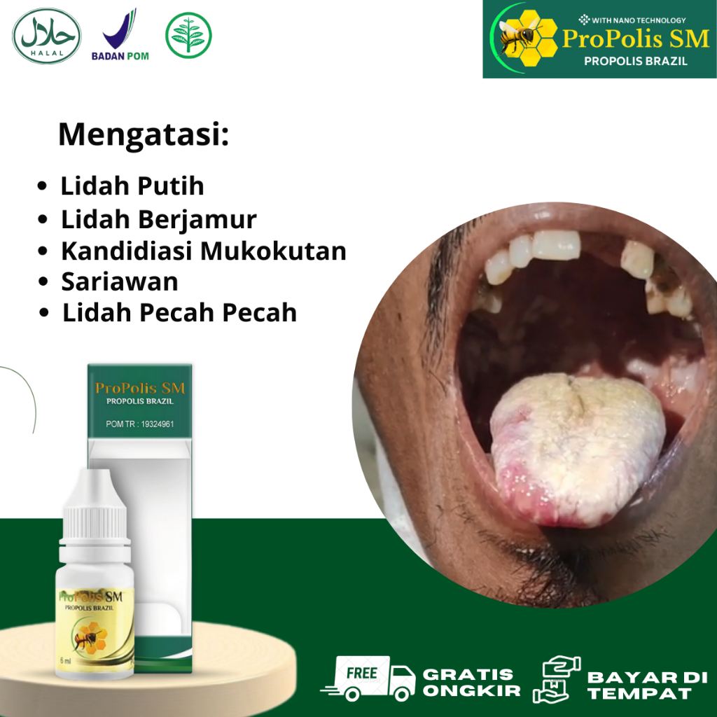 Jual Obat Lidah Putih Berjamur, Kandidiasis Mukokutan, Lidah Pecah ...