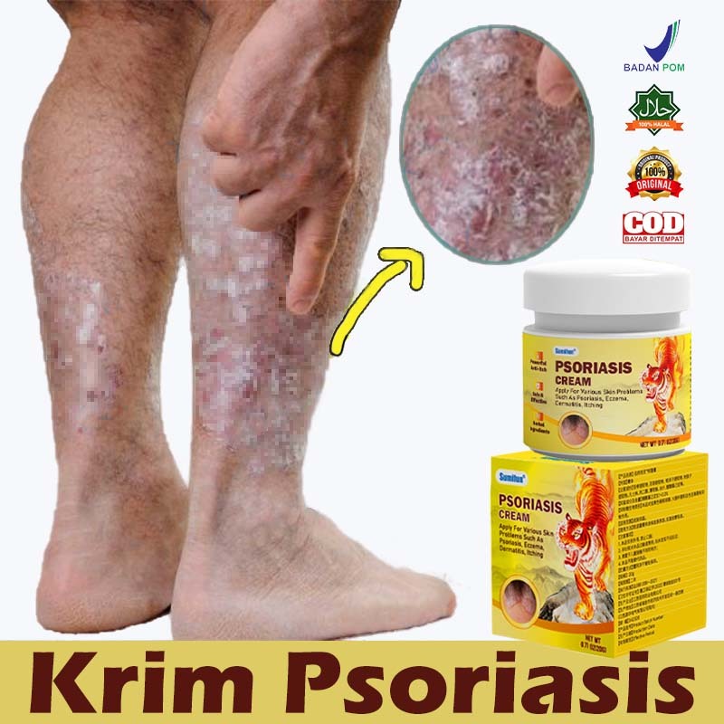 Jual Psoriasis Salep psoriasis Obat kurap Obat kurap paling ampuh Salep ...