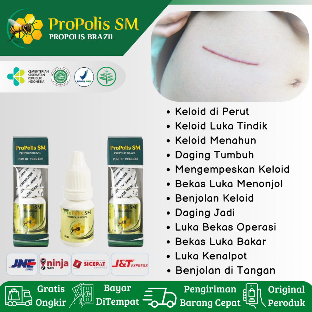 Jual Obat Keloid Daging Tumbuh Daging Jadi Penghilang Keloid Luka Tindik Di Telinga Bekas ...