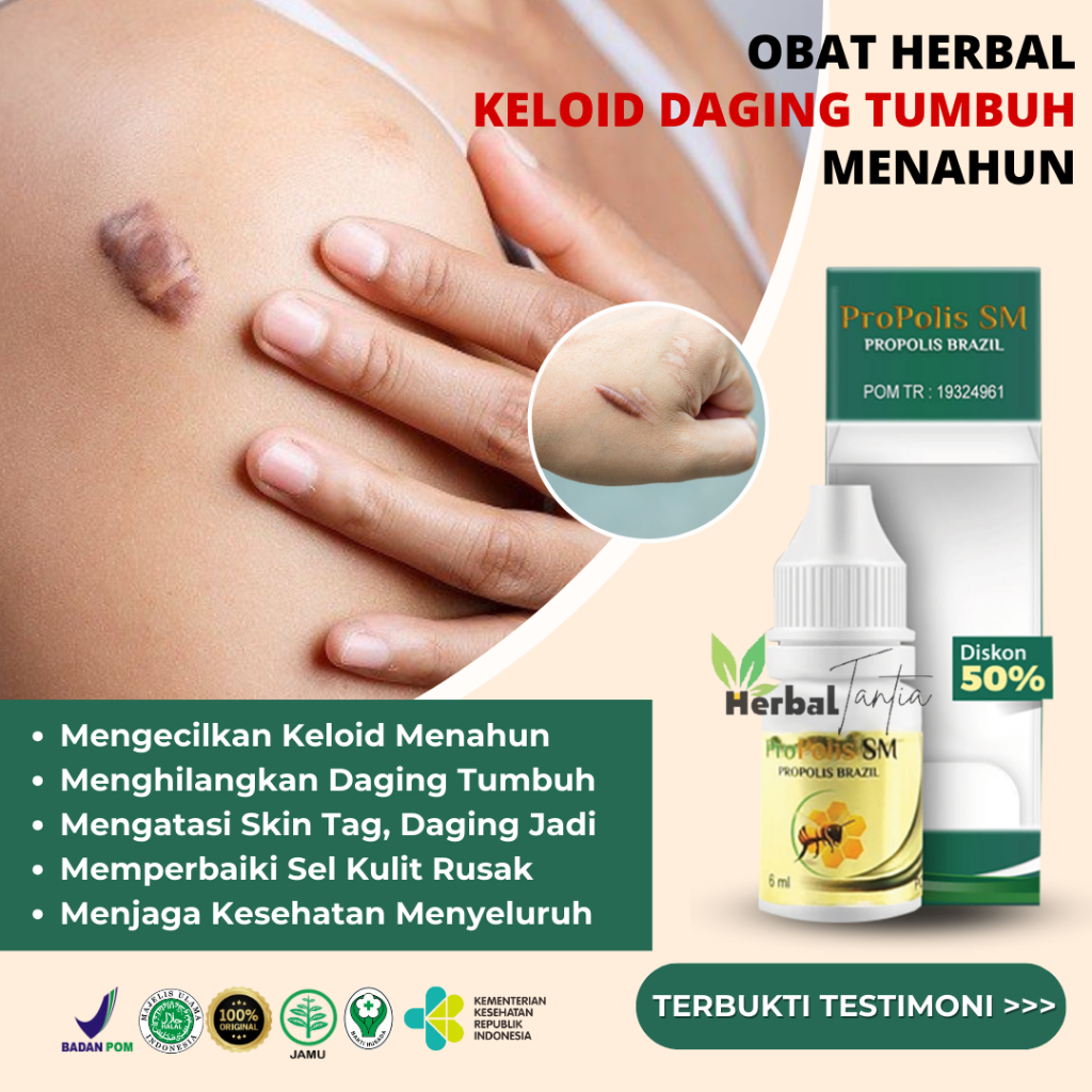 Jual Obat Keloid Daging Tumbuh Menahun Penghilang Bekas Luka Operasi ...