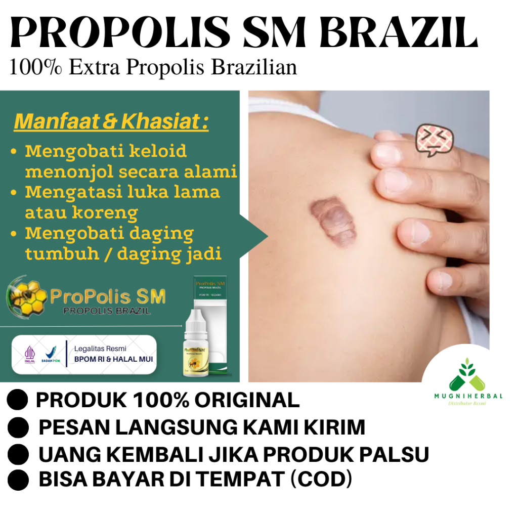 Jual Propolis SM - Obat Keloid Menonjol Tahunan, Daging Tumbuh Di Kulit, Keloid Bekas Luka ...