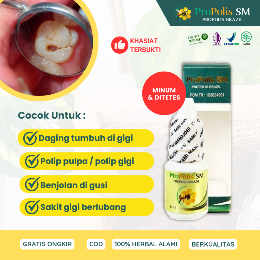 Jual Obat Polip Pulpa Gigi Berlubang, Benjolan di Gusi, Mucocele Herbal ...