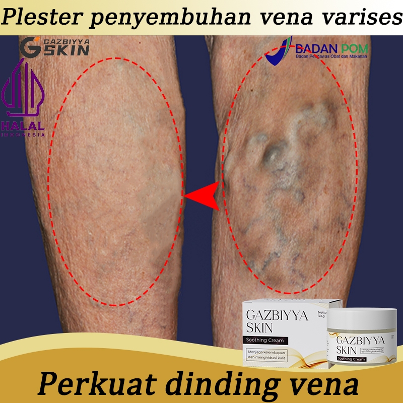 Jual 【BPOM】Obat varises obat varises di kaki dan betis paling ampuh ...