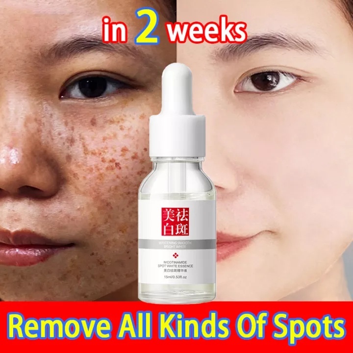 Jual Whitening Freckle Serum Remove Dark Spots Anti Freckle Cream Niacinamide Fade Pigmentation ...