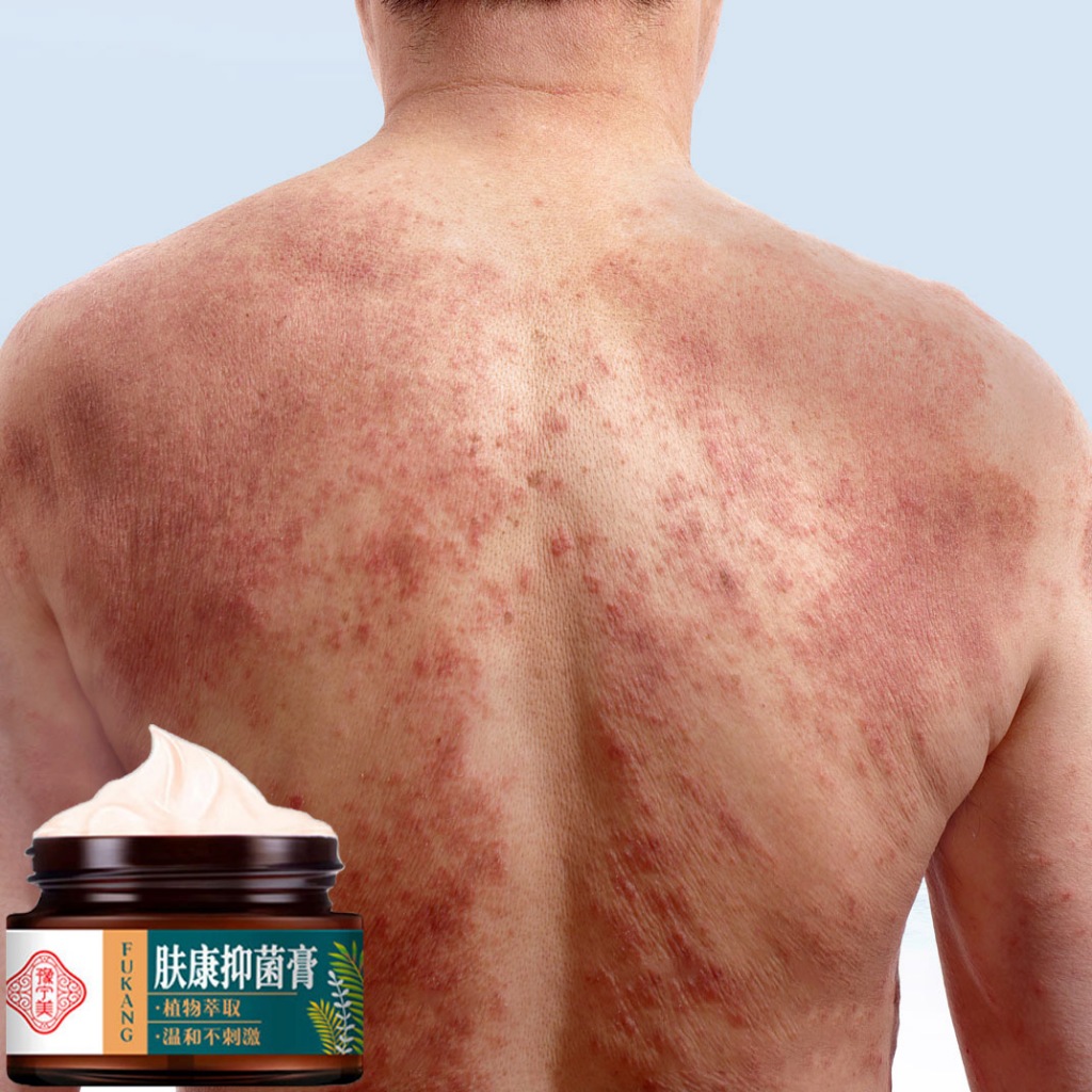 Jual Salep gatal Obat psoriasis obat gatal salep kutil 30G Obat Salep ...