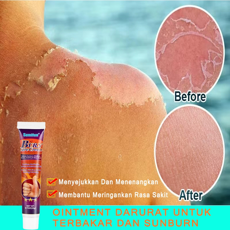 Jual salep luka bakar penghilang bekas luka bakar obat luka bakar salep ...