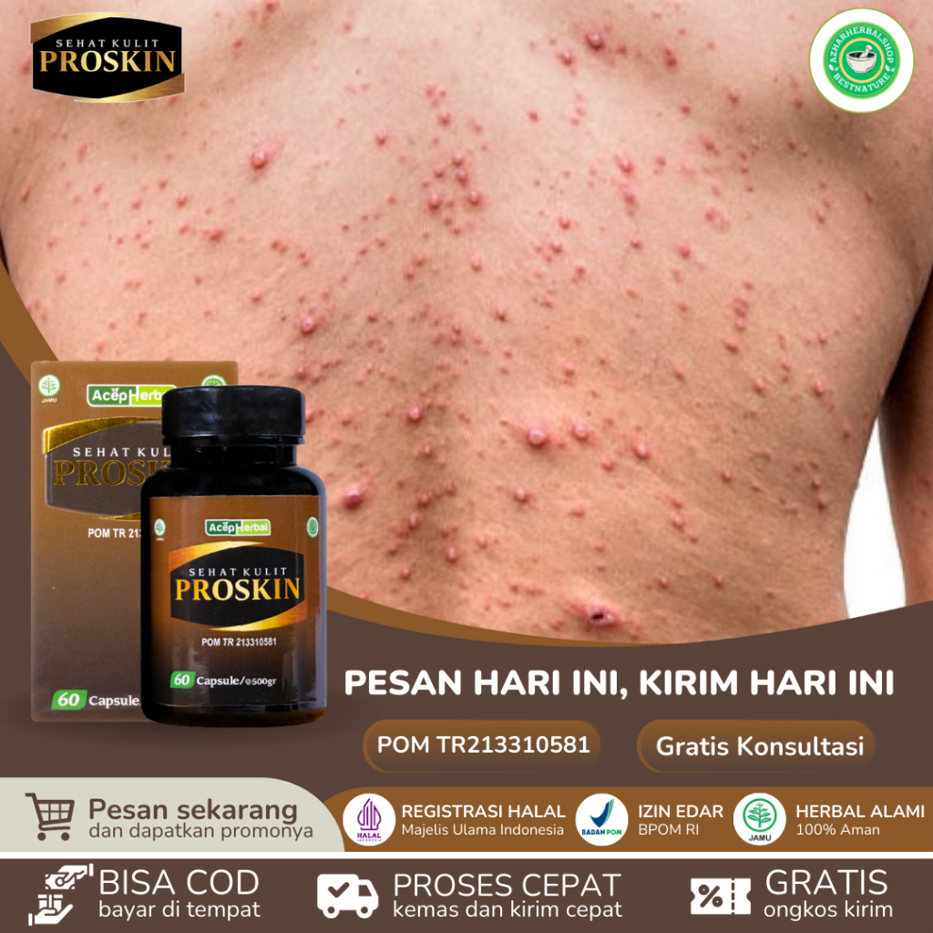 Jual Proskin Obat Cacar herpes zoster atau cacar ular molluscum ...