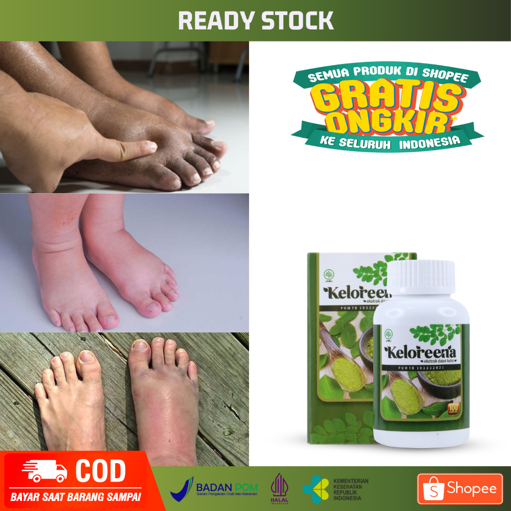 Jual Obat Kaki Bengkak Karena Gula / Diabetes, Asam Urat, Ginjal ... Jual Obat Kaki Bengkak Karena Gula / Diabetes, Asam Urat, Ginjal ...