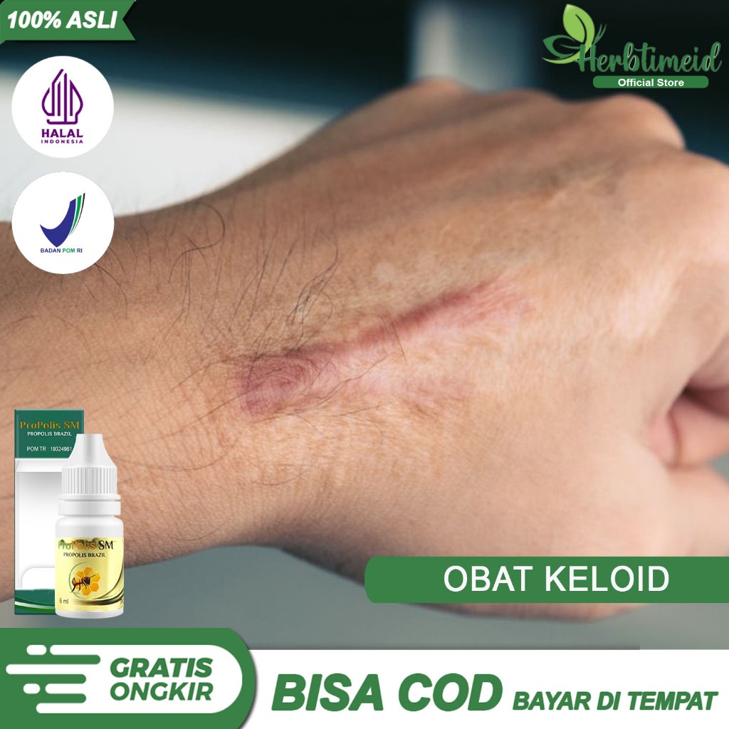 Jual Obat Penghilang Keloid, Daging Tumbuh, Daging Jadi, Luka Tindik ...