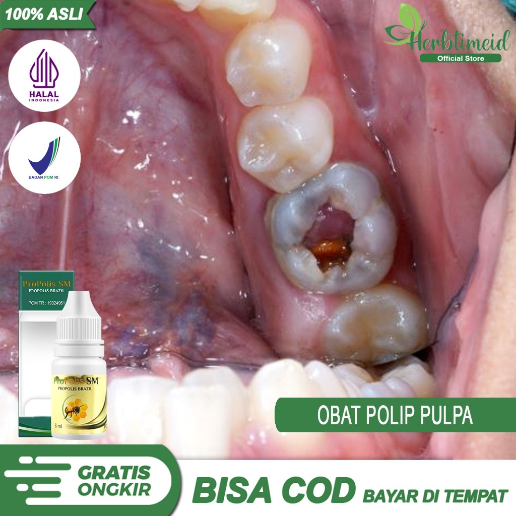 Jual Obat Polip Pulpa, Pembengkakan Pada Pulpa Gigi, Pengecil Benjolan Di Gigi Berlubang ...