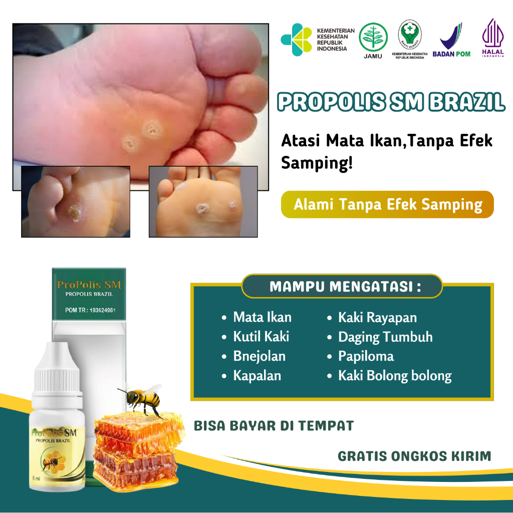 Jual Obat Mata Ikan Kutil di Kaki Tangan Tumbuh Papiloma Anak Dewasa ...
