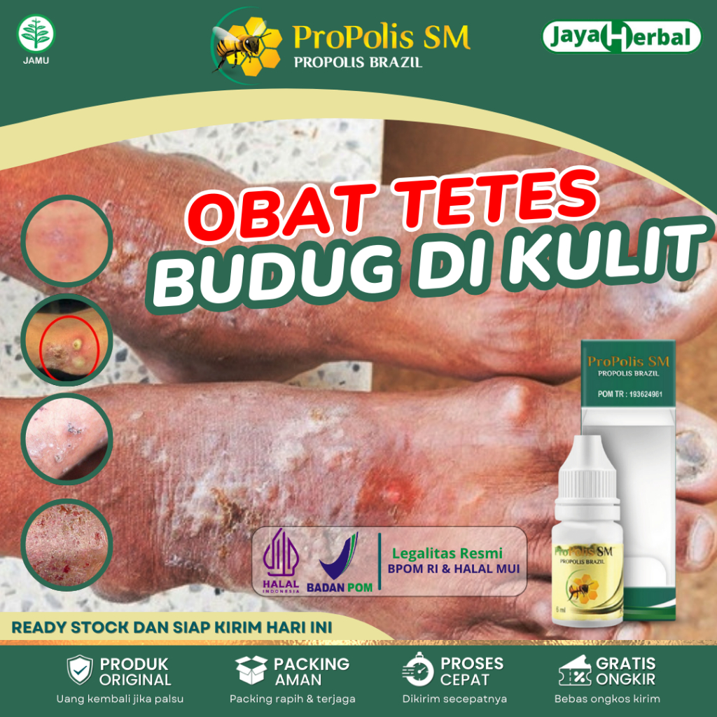 Jual Jaya Herbal - Obat Budug Di Kaki, Cenang Bernanah, Scabies Manusia ...