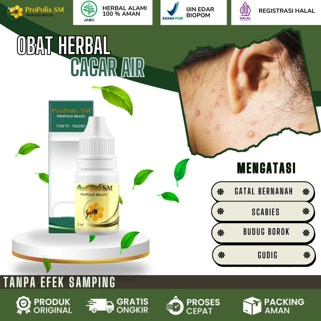 Jual Propolis SM - Obat Herbal Cacar Air & Bekas Cacar, Herpes Zoster ...