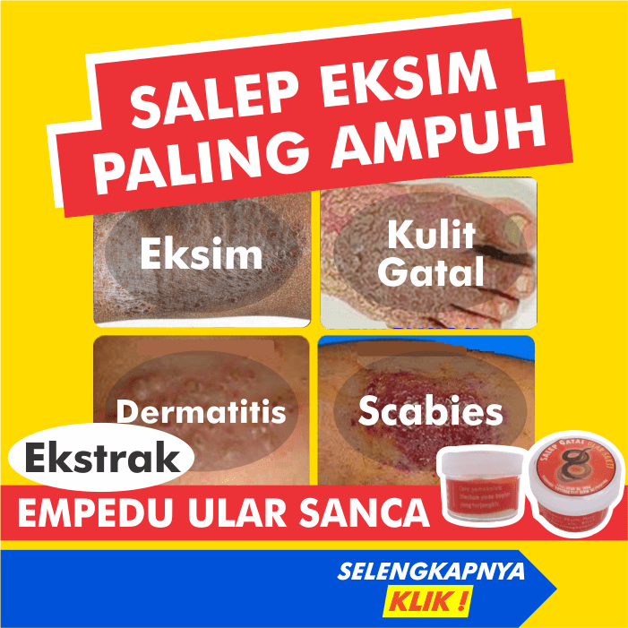 Jual Salep Obat Gatal Kulit Eksim Kering Paling Ampuh Gatel Exim Salap ...