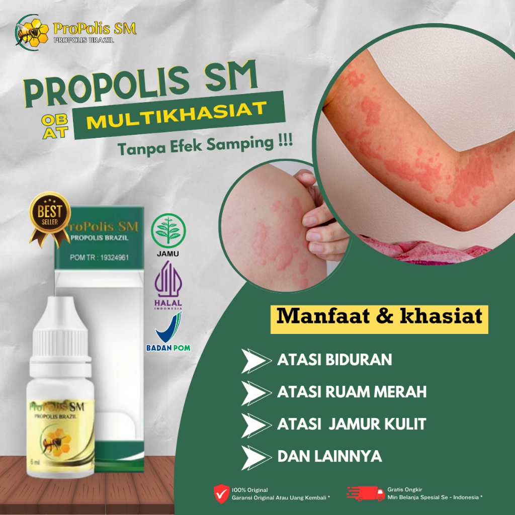 Jual Obat Penyakit Biduran, Obat Kaligata, Obat Ruam Merah Perih, Obat ...