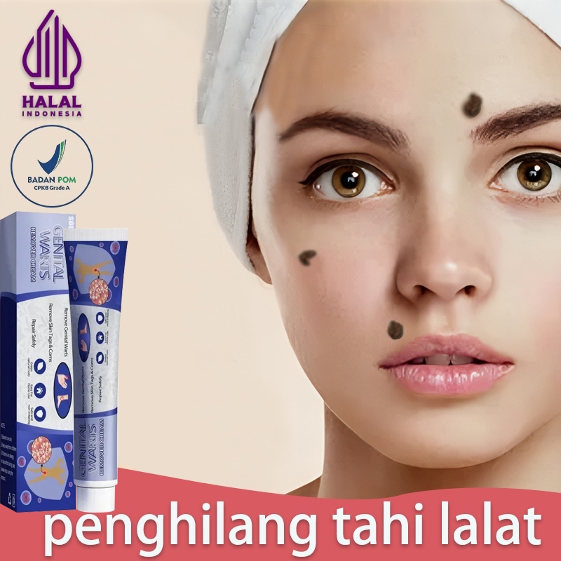 Jual Krim penghilang tahi lalat Penghilang Kutil Dan Tahi Lalat Obat ...