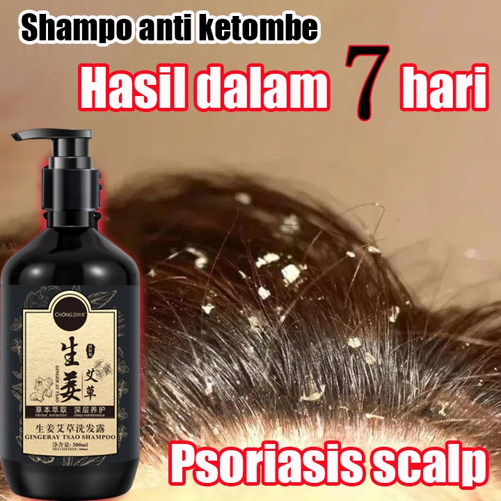 Jual Sampo Anti Ketombe Sampo Ketombe Shampo Kutu Rambut 300ml Ginger Shampoo Herbal Penumbuh ...