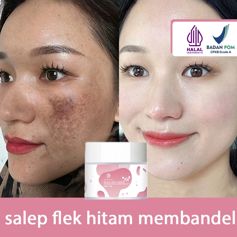 Jual 【BPOM】Cream flek hitam membandel bpom krim penghilang flek hitam serum flek hitam membandel ...