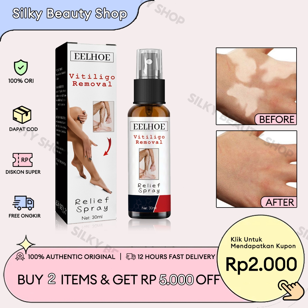 Jual EELHOE Obat Vitiligo Spray 30ml Salep Vitiligo Ori 100% Vitiligo ...